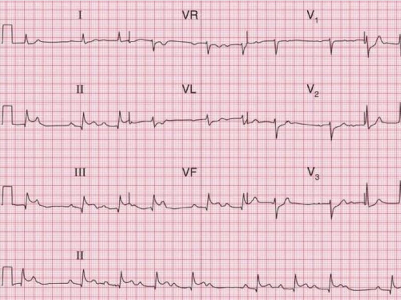 ECG Interpretation Course