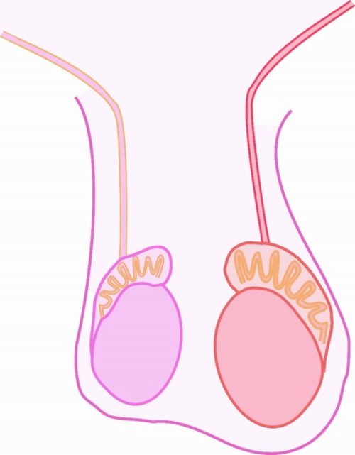 Epididymo Orchitis Clinical Features Frcem Mrcem Ultrasound